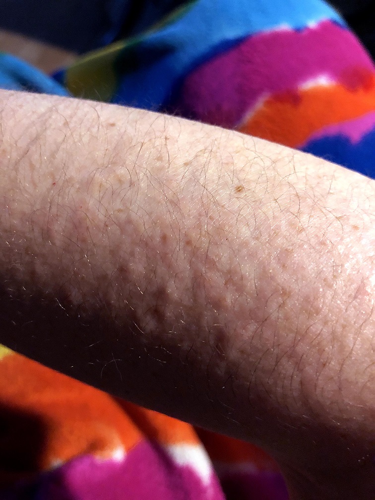 polymorphous light eruption | Eigenblogger